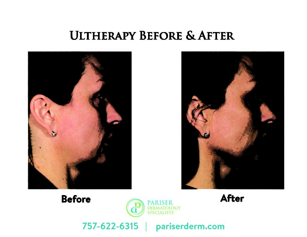 Ulth Before and After Stock Neck jpeg - Pariser Dermatology
