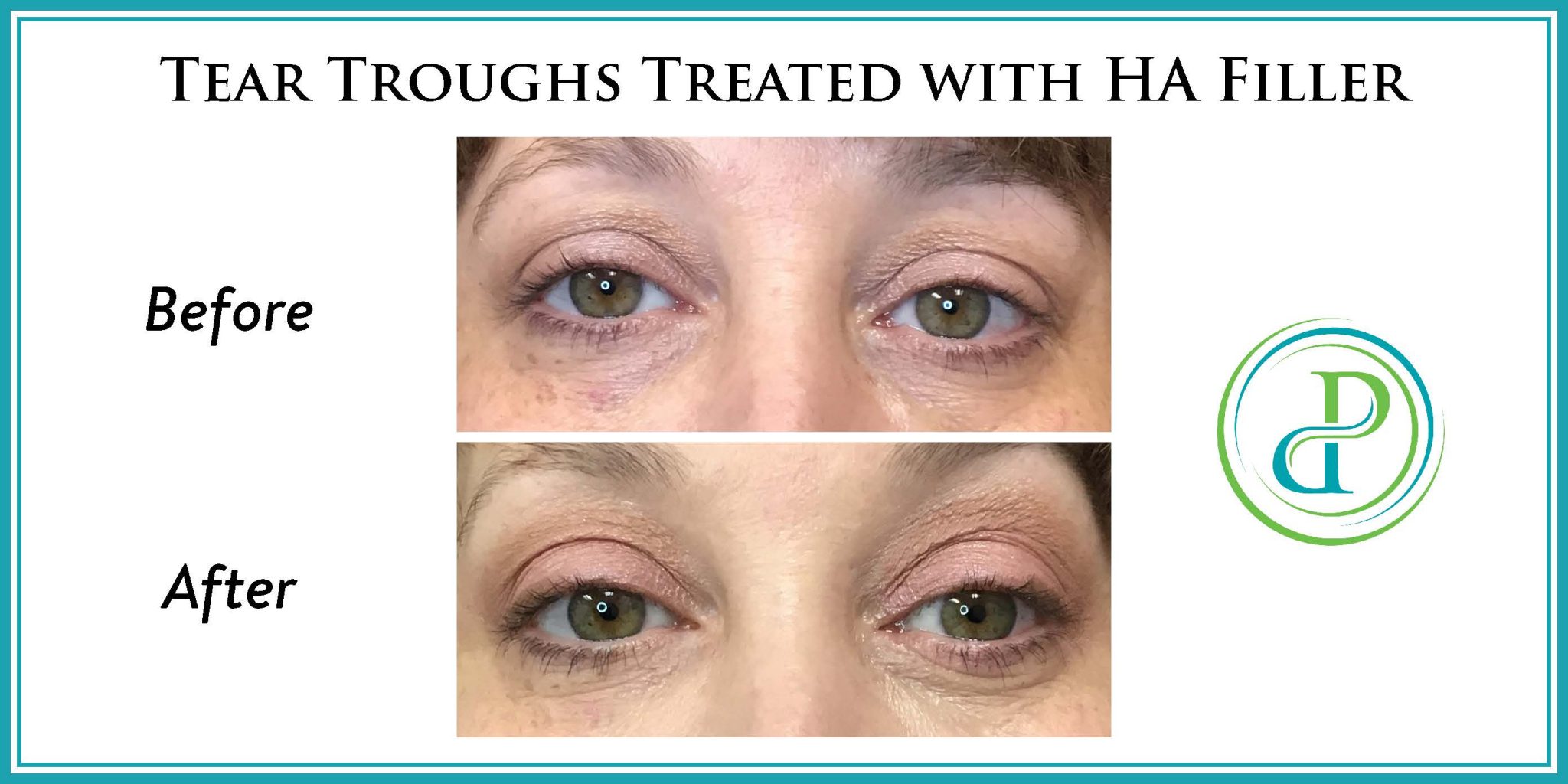 Dark Circles under Your Eyes? HA Filler Can Help - Pariser Dermatology