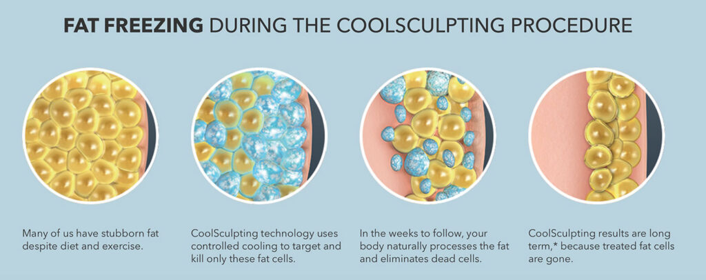 CoolSculpting